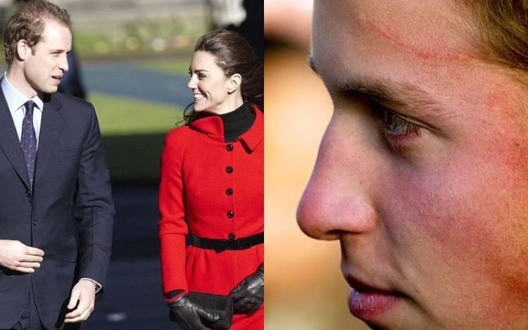 Kate Middleton's hidden scar on her head is exposed. Did she have an ...